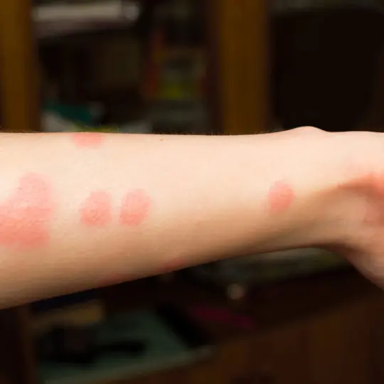 How to Prevent Flea Bites - Green Pest Solutions